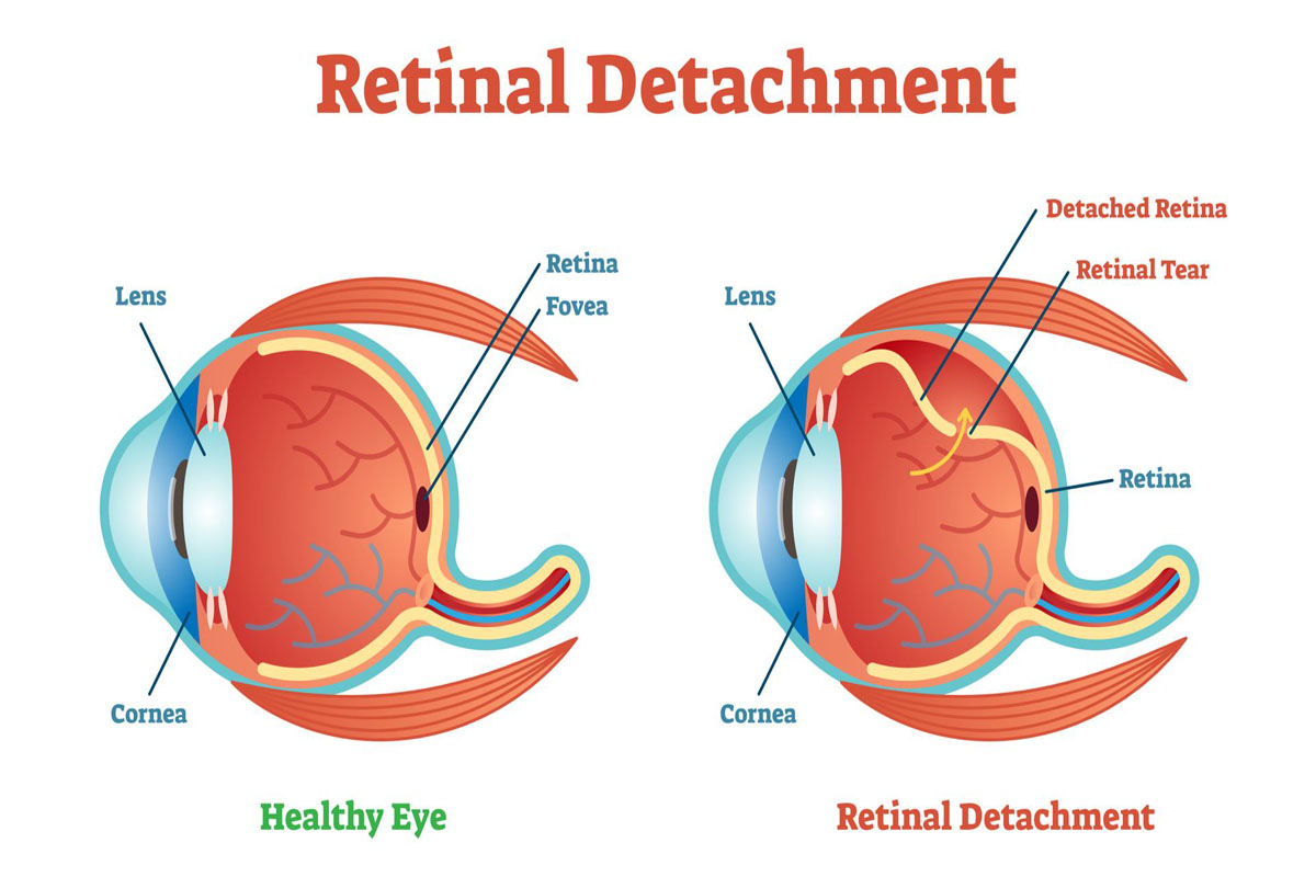 Vitreoretinal : Ratnam Superspeciality Eye Hospital Rajajipuram Lucknow